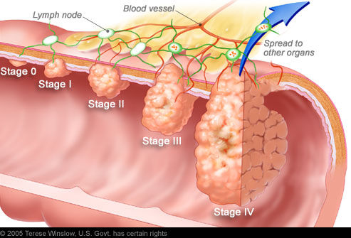 Pancreatic Cancer at emaze Presentation