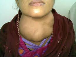 hyperthyroidism at emaze Presentation