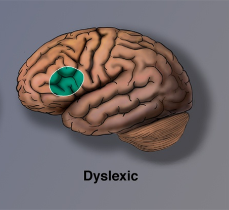 DYSLEXIA on emaze