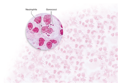 Diseases of Genitourinary System on emaze