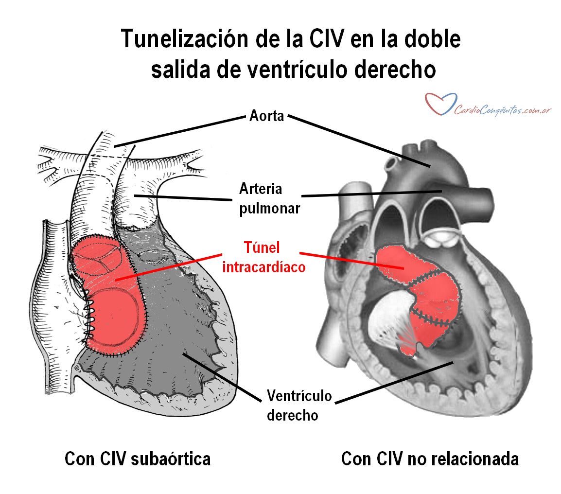 Doble salida del ventrículo derecho.pptx on emaze