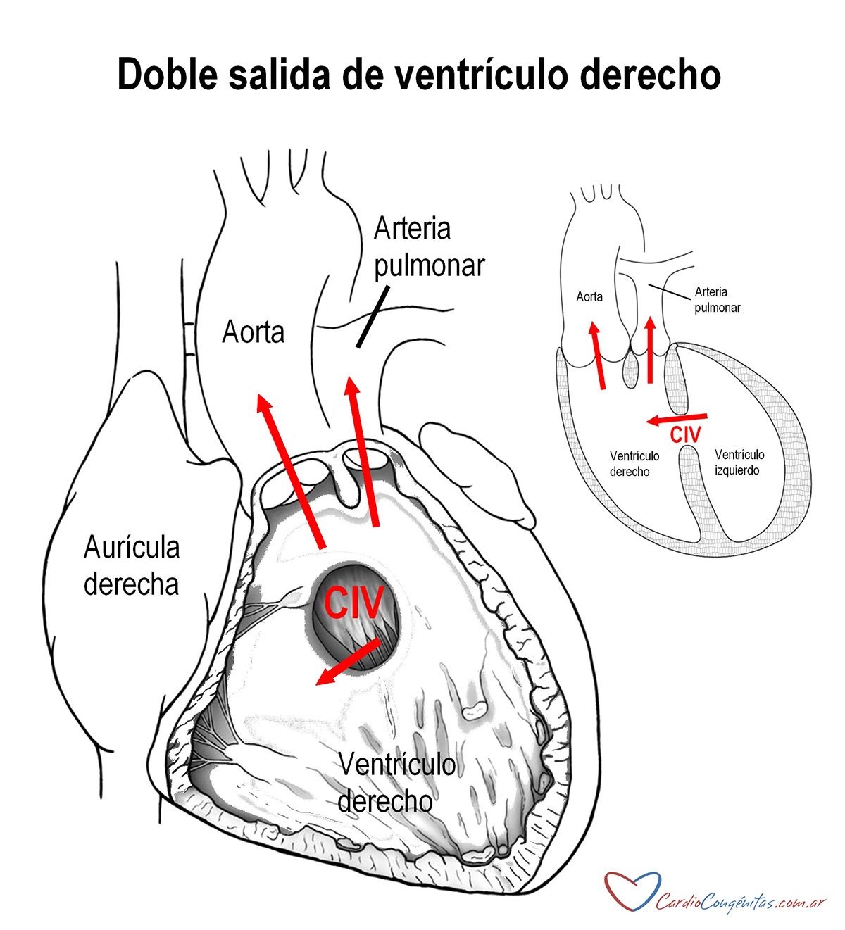 Doble salida del ventrículo derecho.pptx on emaze