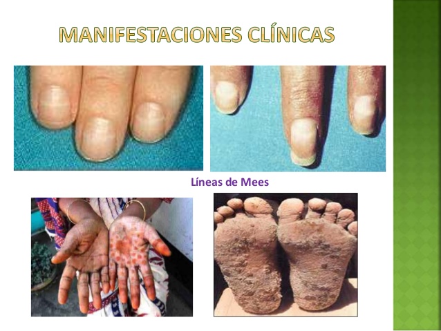 neumoconiosis on emaze