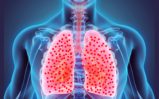Tuberculosis on emaze