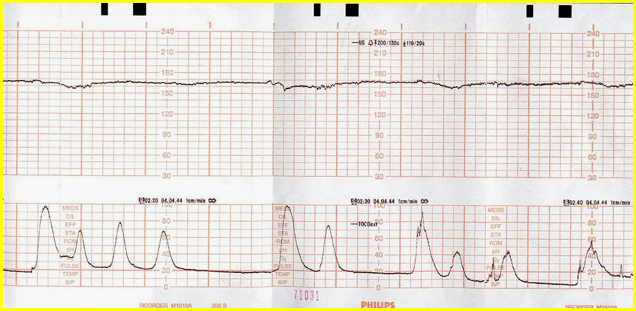 Pruebas de bienestar fetal on emaze