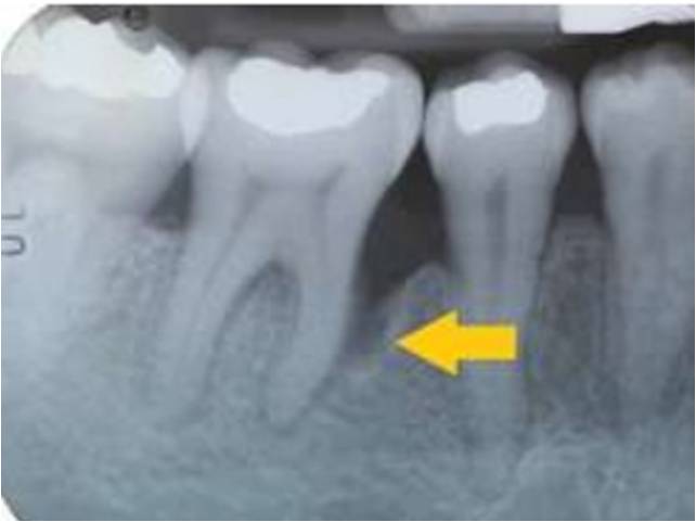 Bone loss& patterns on emaze