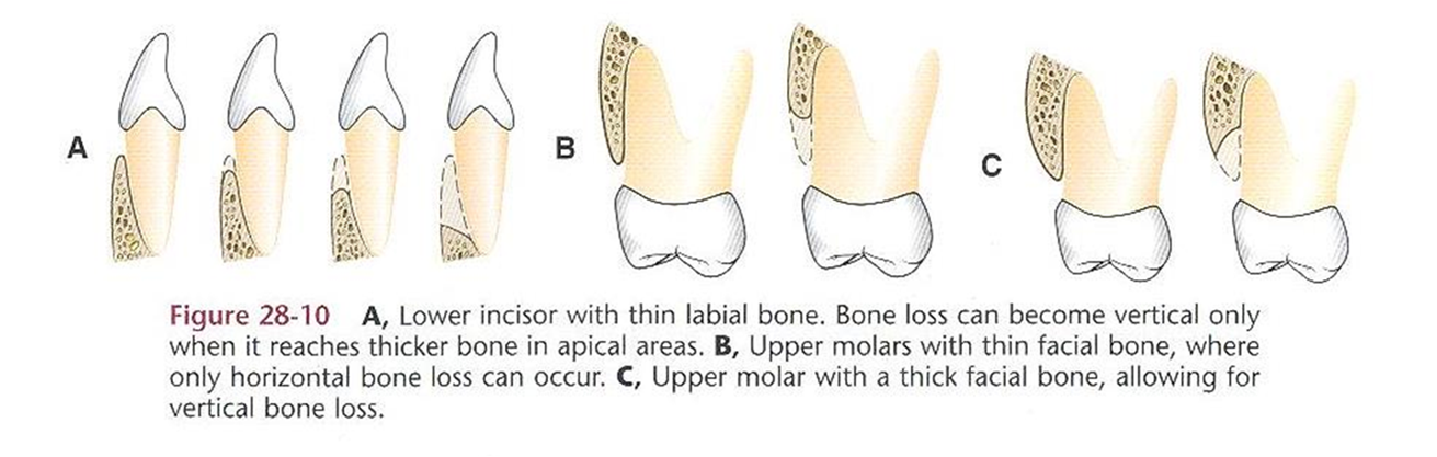 Bone loss& patterns at emaze Presentation