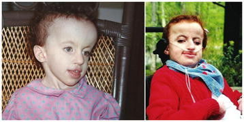 Edwards' Syndrome on emaze