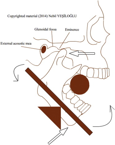 TMJ dislocation at emaze Presentation