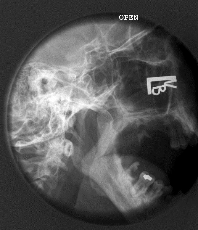 TMJ dislocation at emaze Presentation