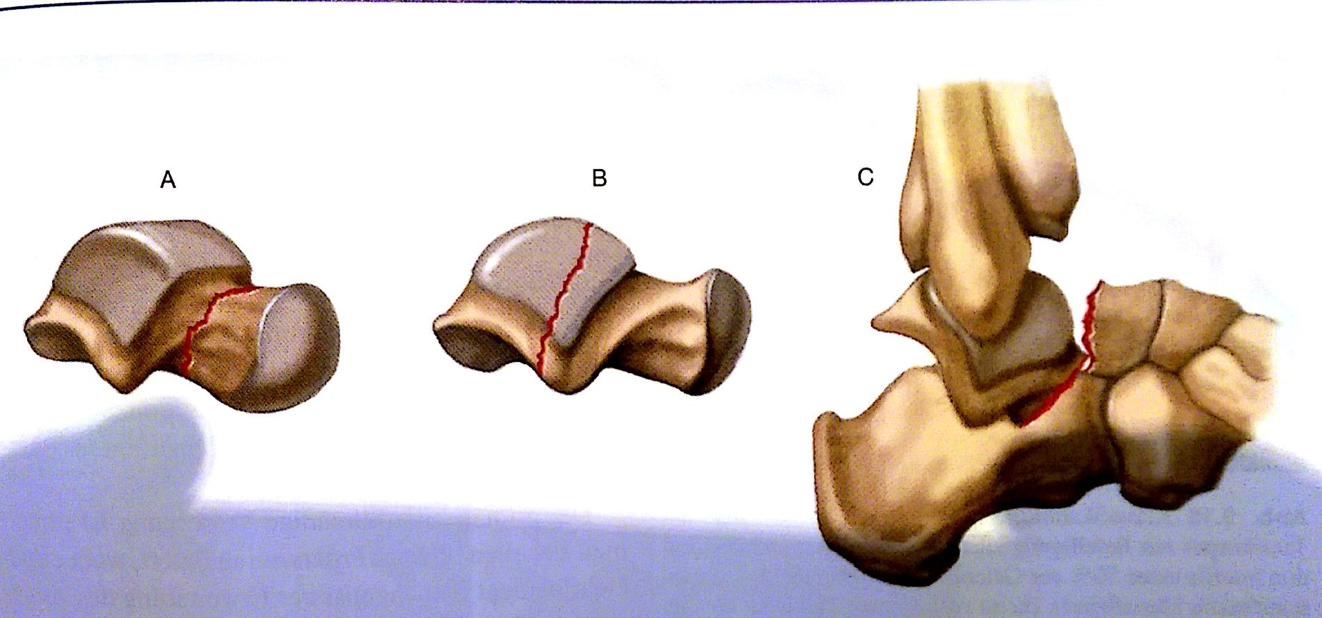 Talus Frakturen on emaze