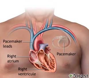 The Pacemaker at emaze Presentation