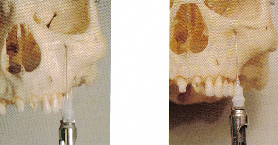 Maxillary Anesthesia -2.pptx at emaze Presentation