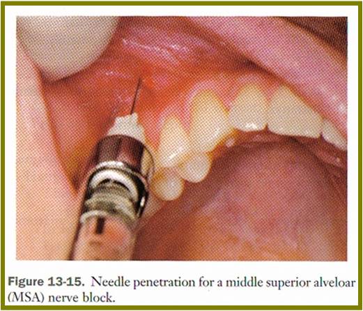 Maxillary Anesthesia -2.pptx at emaze Presentation