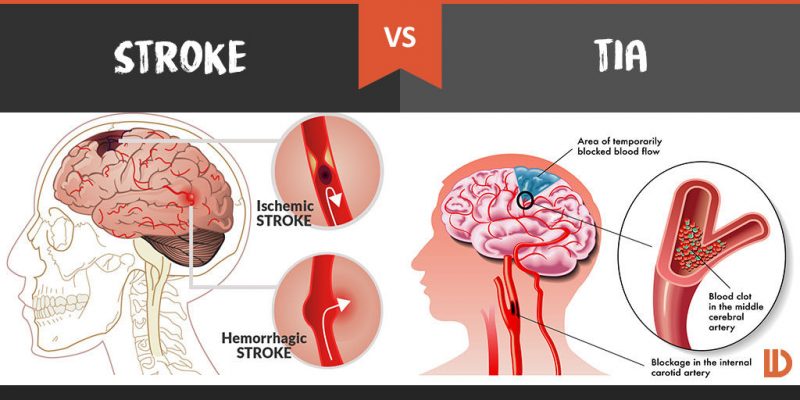Transient ischemic Attack on emaze