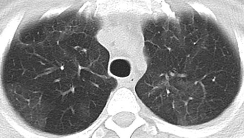 Mosaic Attenuation on emaze