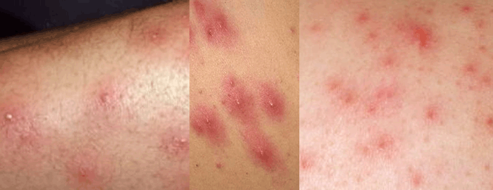 Foliculitis at emaze Presentation