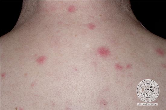 Sweet's Syndrome at emaze Presentation