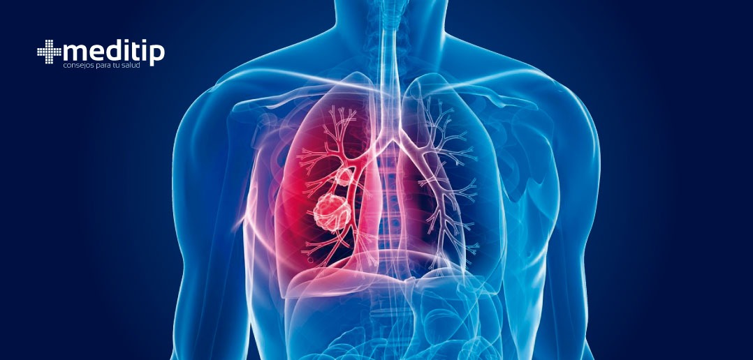 TUBERCULOSIS on emaze