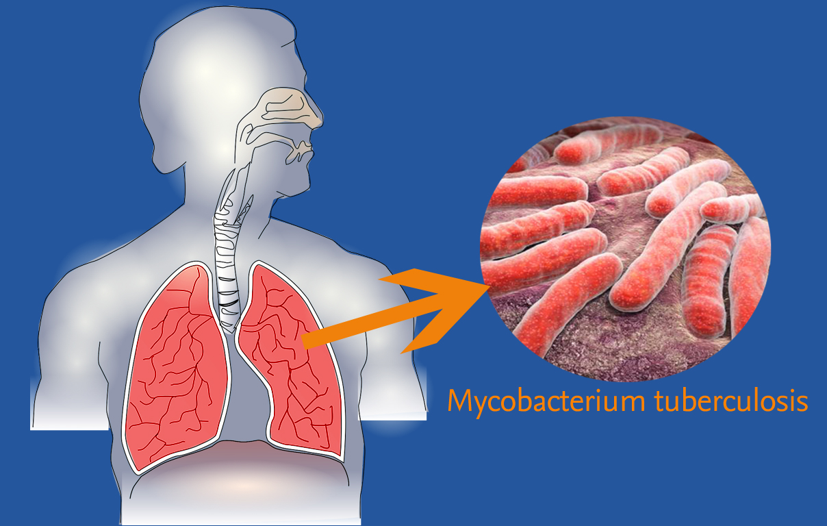 TUBERCULOSIS on emaze