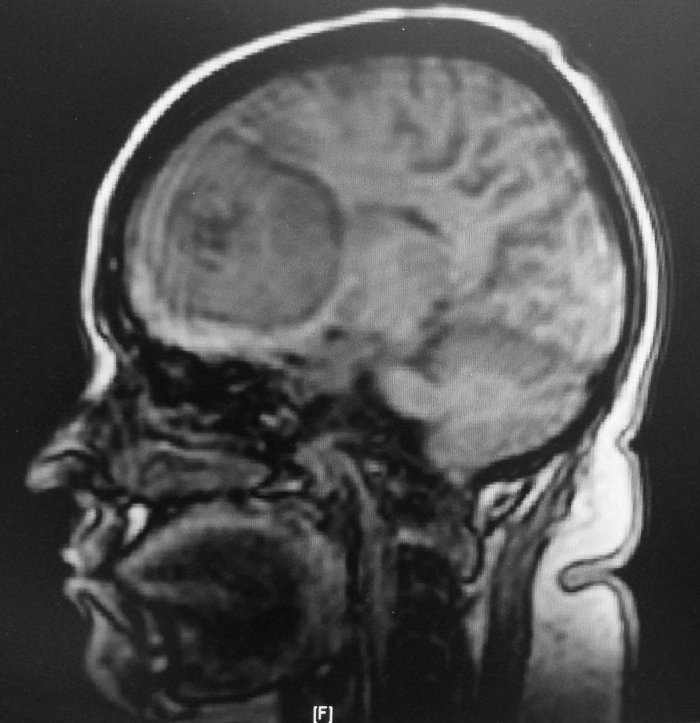 Orbitofrontal copy1 on emaze