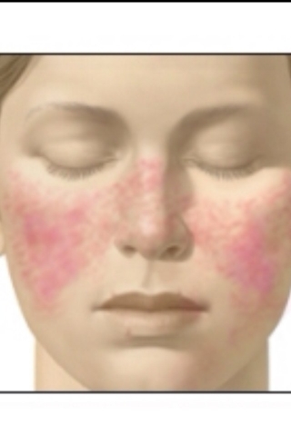 Malar Rash on emaze