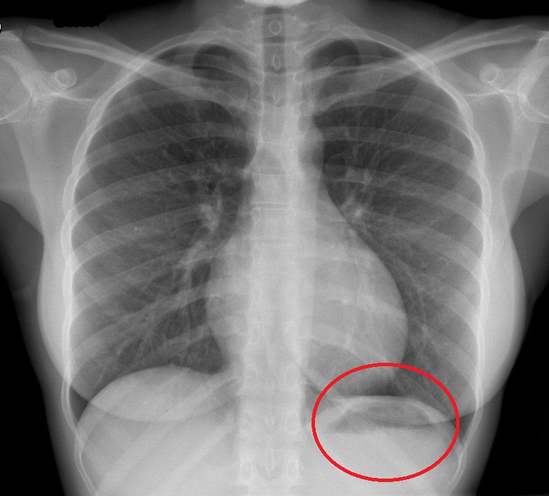 Radiographie Thoracique on emaze