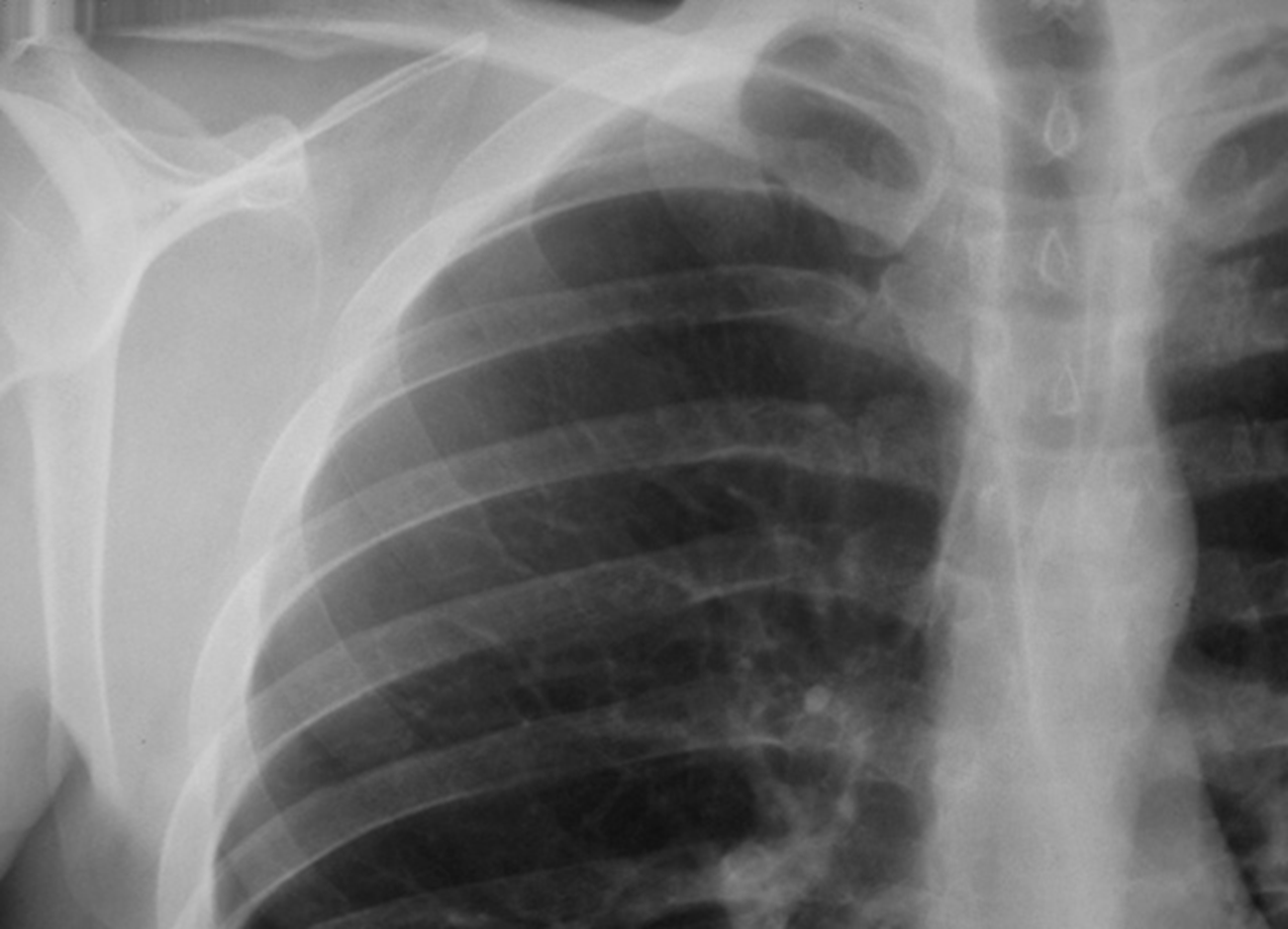 Radiographie Thoracique on emaze