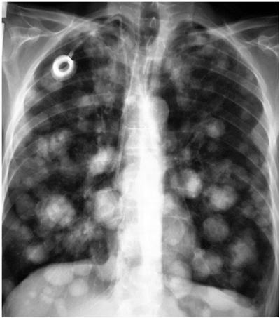 Radiographie Thoracique on emaze