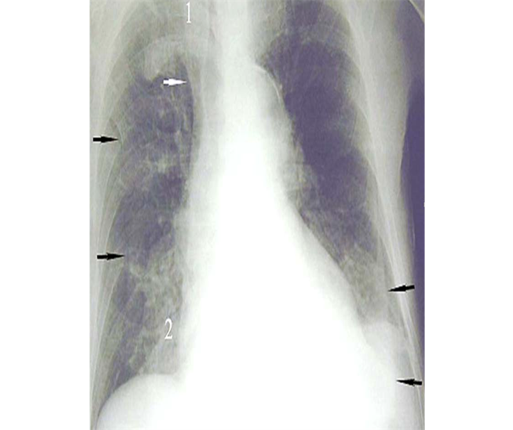 Radiographie Thoracique on emaze
