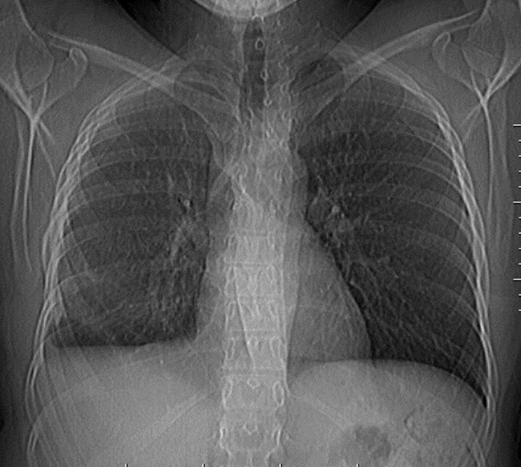 Radiographie Thoracique on emaze