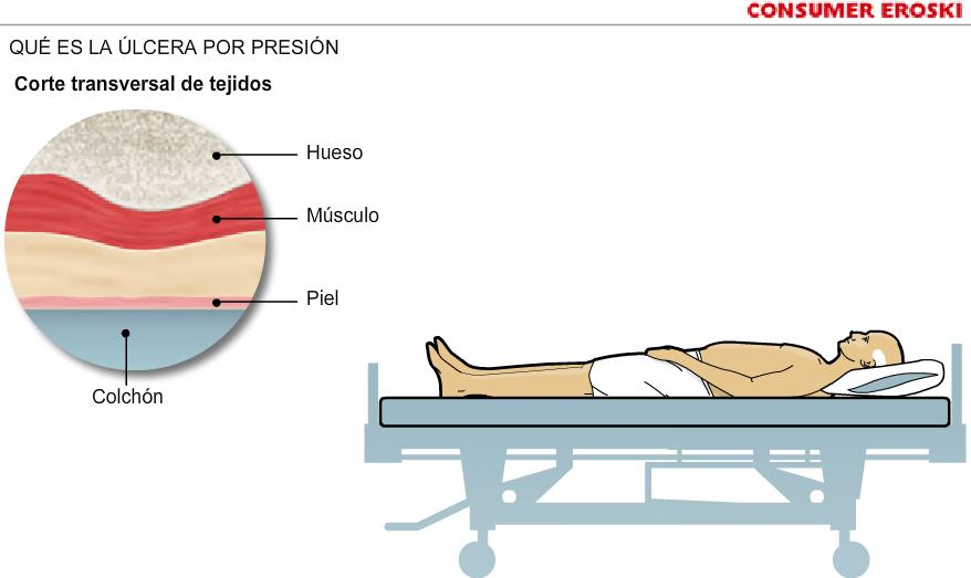 ULCERAS POR PRESION at emaze Presentation