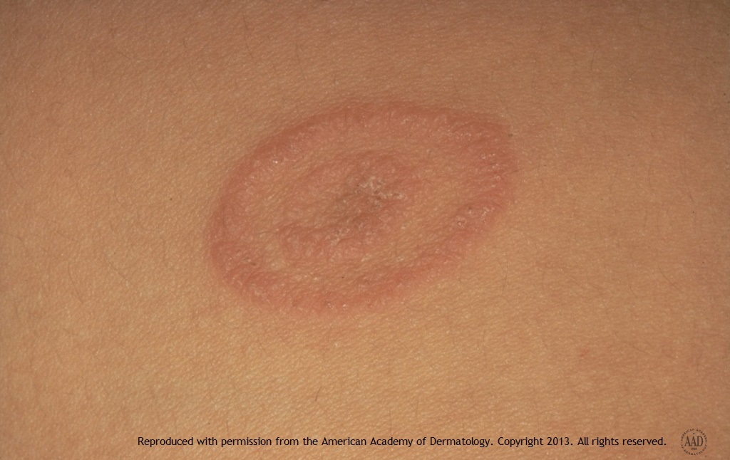 History of ringworm by Kevin Sullivan on emaze