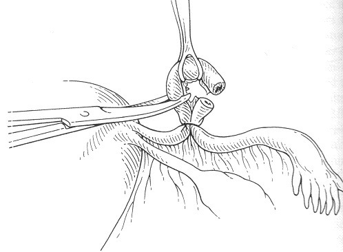 histerectomia y pomeroy at emaze Presentation