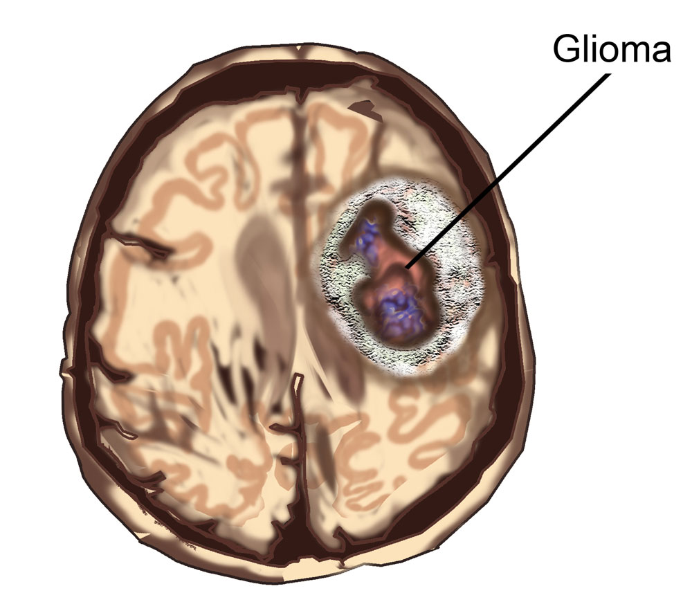 Tumoret e trurit at emaze Presentation