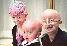 Progeria on emaze