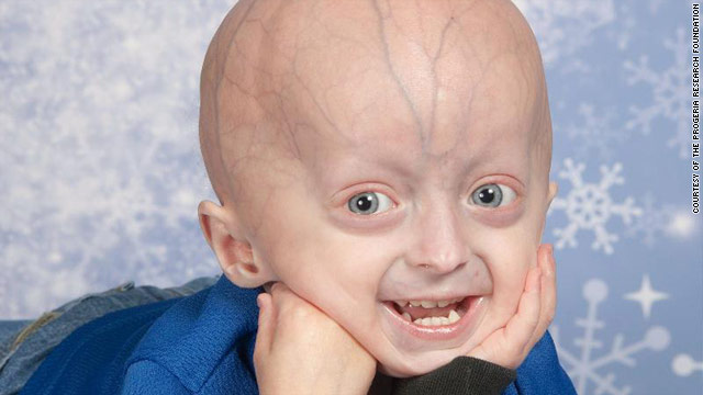 Progeria on emaze