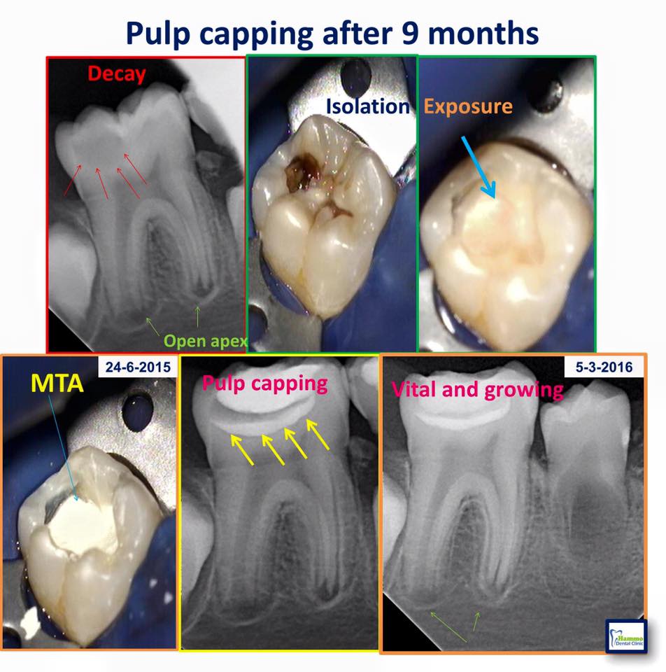 Recubrimiento pulpar on emaze
