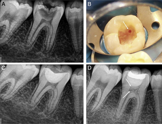 Recubrimiento pulpar on emaze