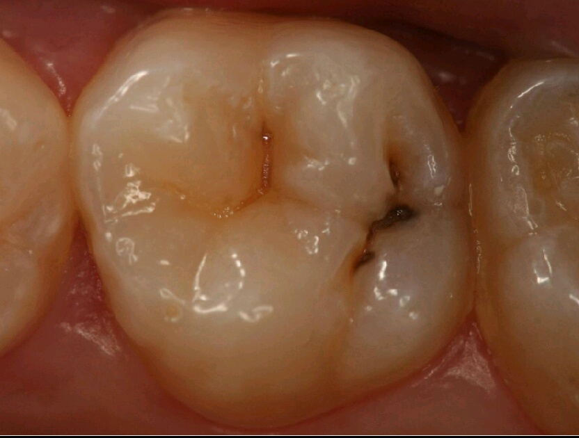 Caries Dental copy1 on emaze