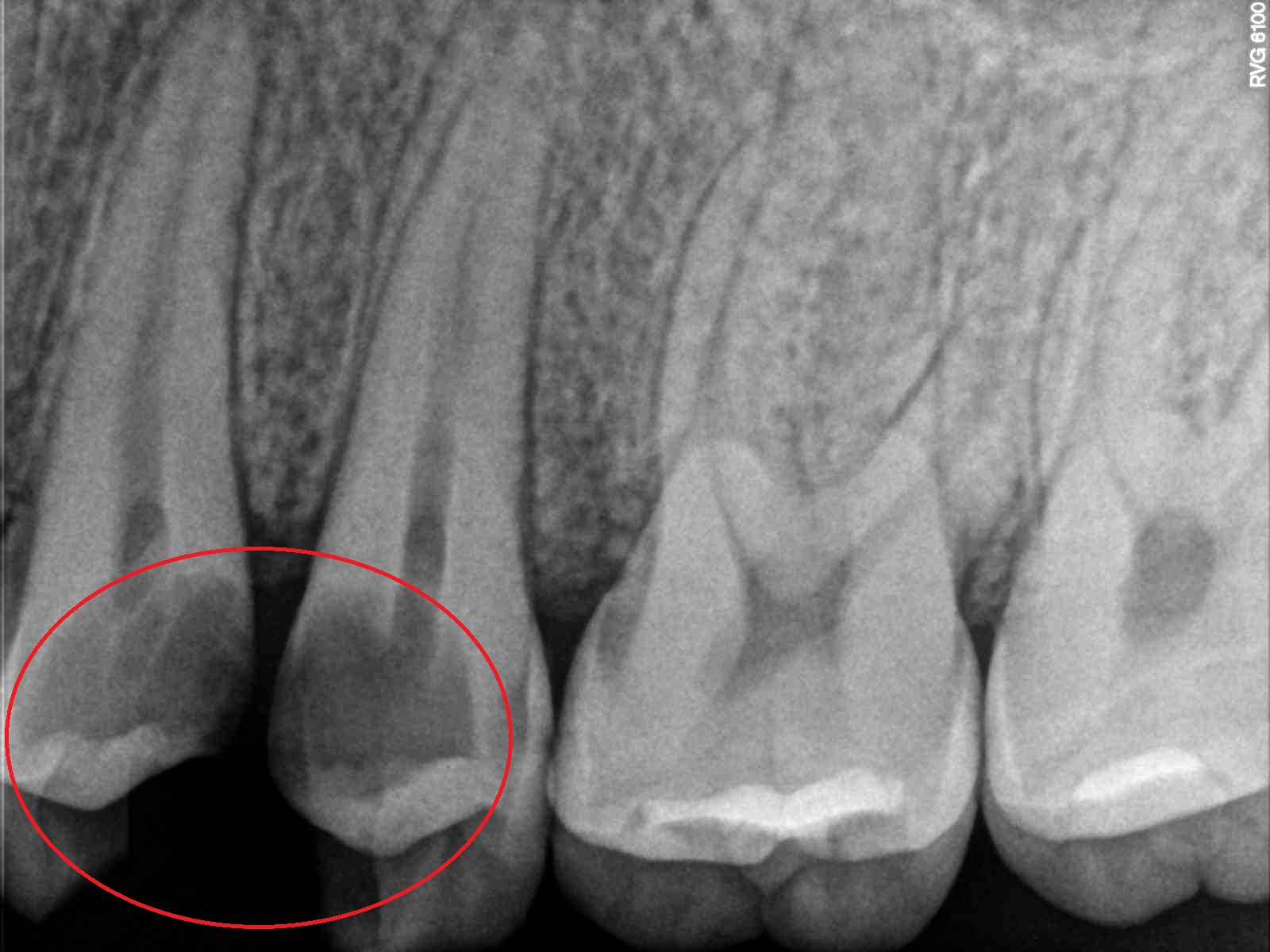 Caries Dental copy1 on emaze