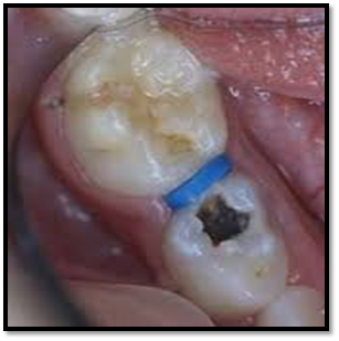 Caries Dental copy1 on emaze