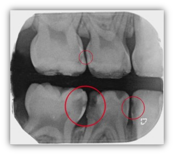 Caries Dental copy1 on emaze