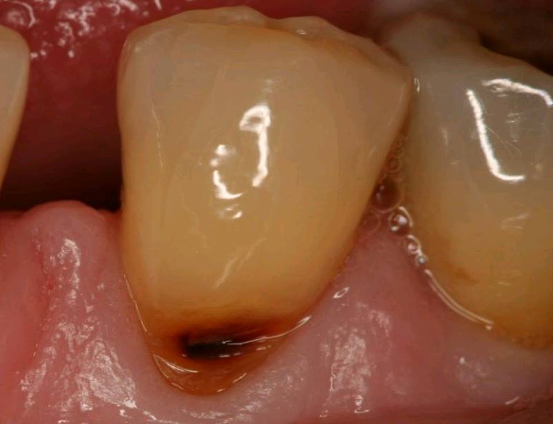 Caries Dental copy1 on emaze