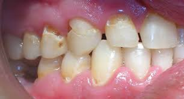 Caries Dental copy1 on emaze