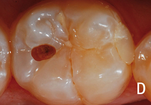 Caries Dental copy1 on emaze