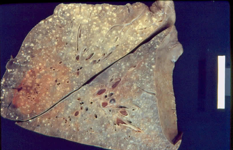 Tuberculosis on emaze