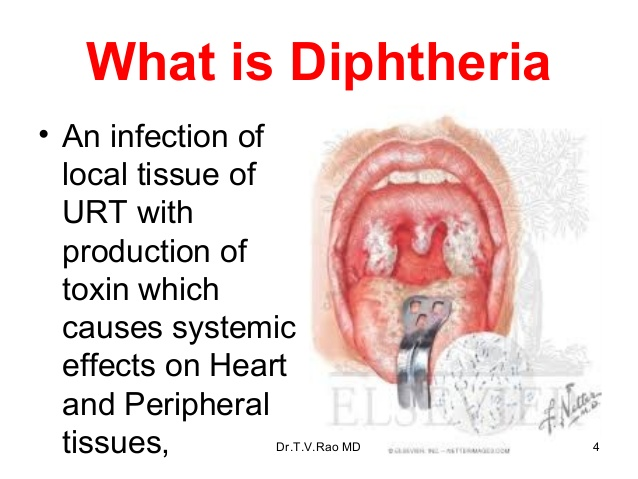 Diphtheria on emaze