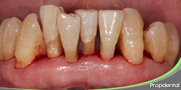 periodontitis on emaze