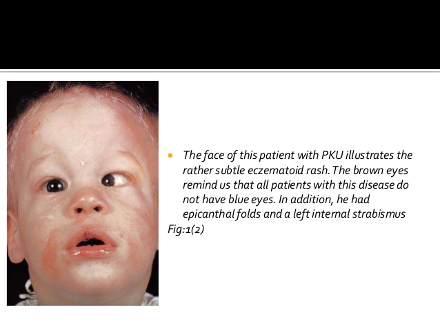Phenylketonuria at emaze Presentation